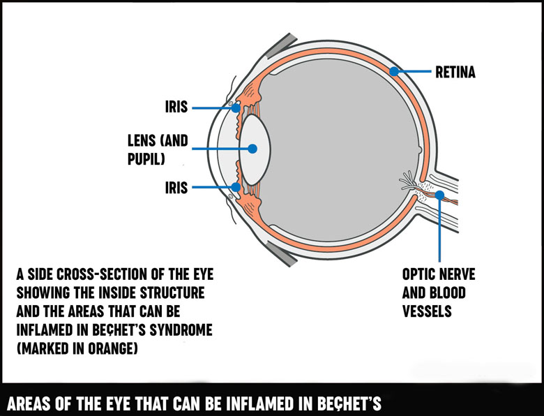 Behçet的综合征|原因，症状，治疗 - beplay3体育